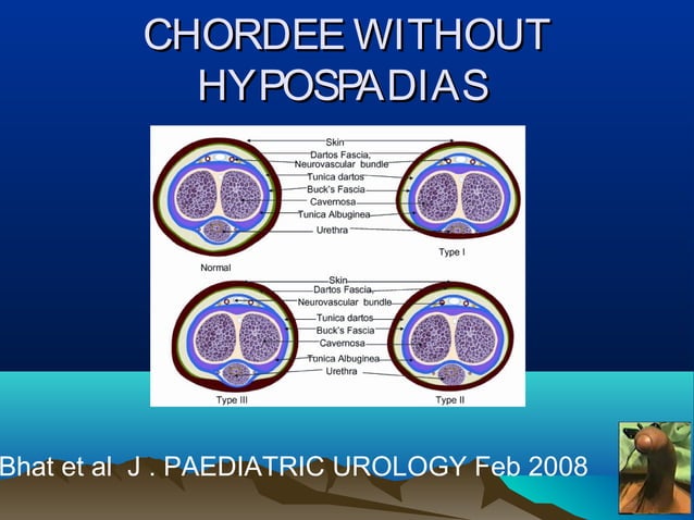 A rational approach in Chordee without hypospadias | PPT