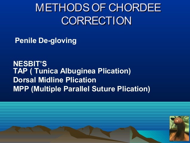 A rational approach in Chordee without hypospadias