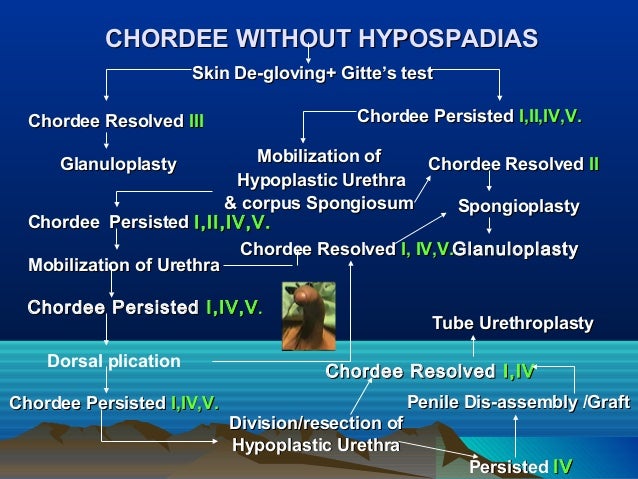 A rational approach in Chordee without hypospadias