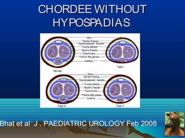 A rational approach in Chordee without hypospadias
