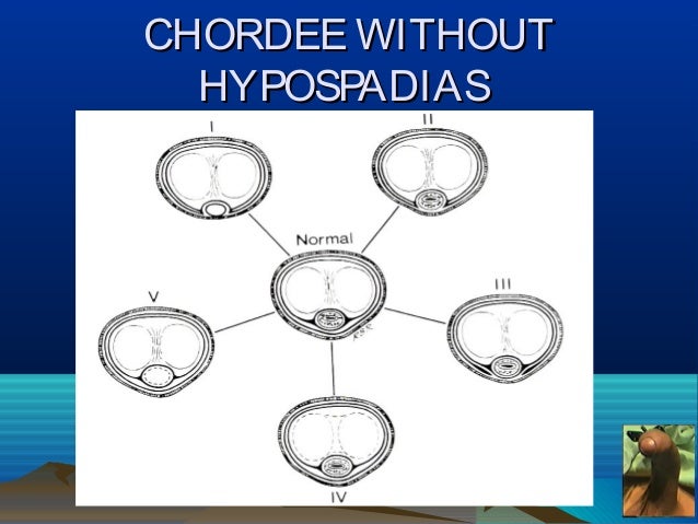 A rational approach in Chordee without hypospadias