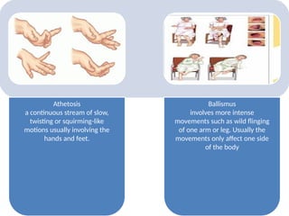 Chorea powerpoint presentation for students | PPTX
