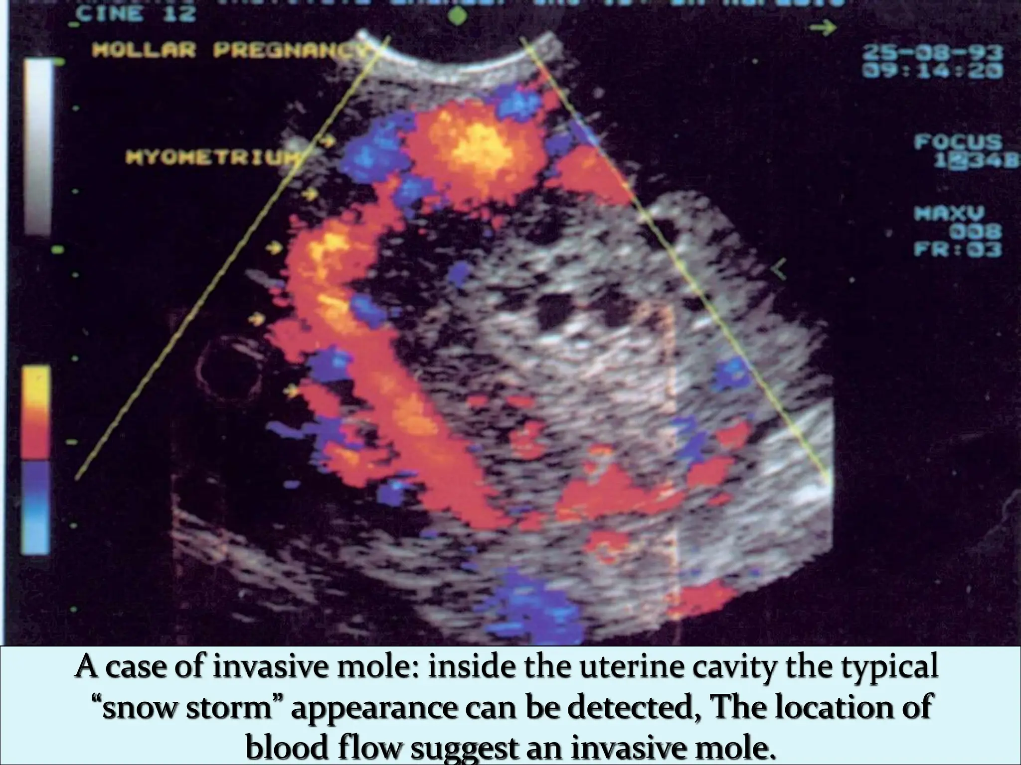 choriocarcinoma ppt.pptx