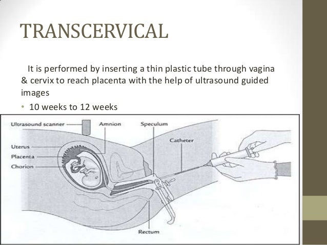 Chorionic villus sampling