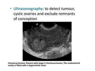 Choriocarcinoma Stage 3