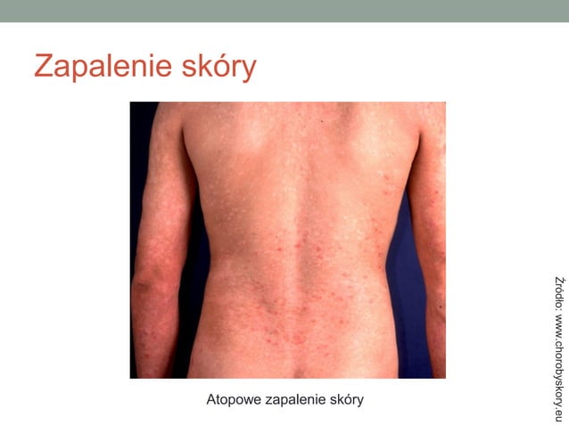 Choroby skóry | PPT