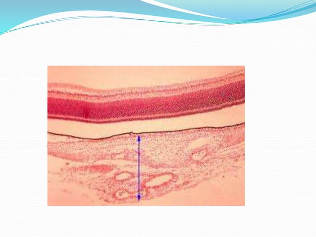 Choroid | PPTX | Eye and Vision Conditions | Diseases and Conditions