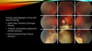 Uveal disease....choroidal coloboma and RD.pptx