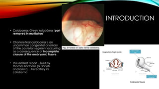 Uveal disease....choroidal coloboma and RD.pptx