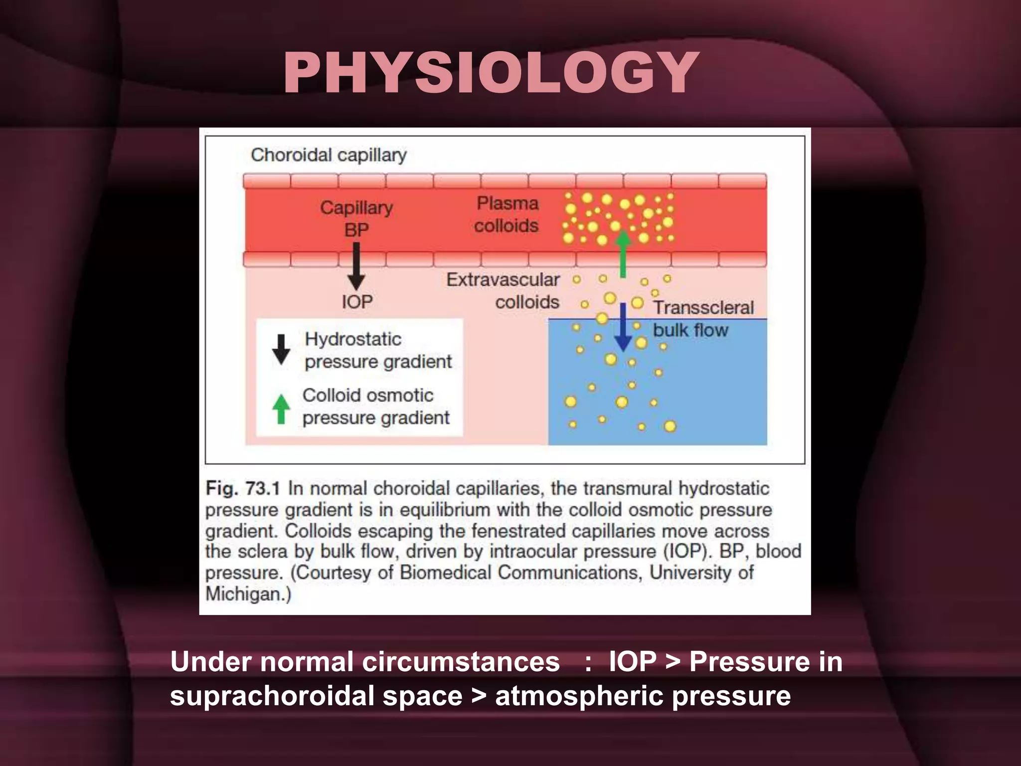 Choroidal detachment | PPTX