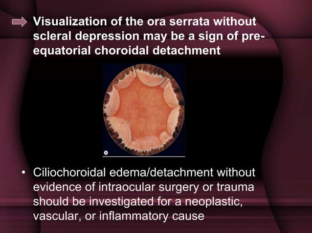 Choroidal detachment | PPTX | Eye and Vision Conditions | Diseases and ...