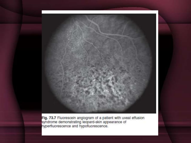 Choroidal detachment | PPTX | Eye and Vision Conditions | Diseases and ...