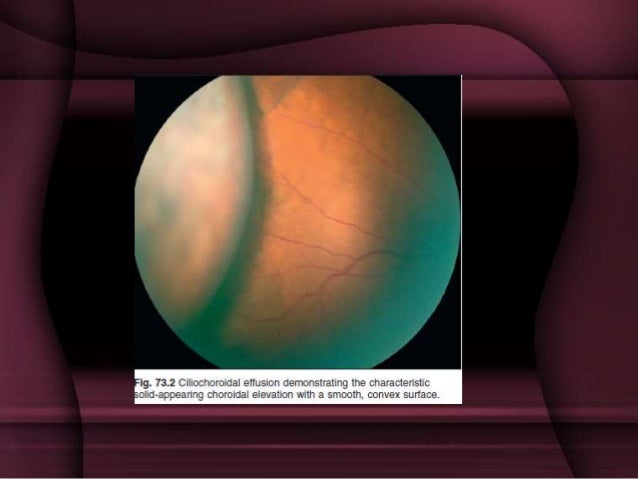Choroidal detachment
