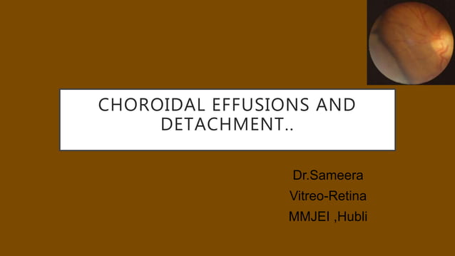 Choroidal detachment -Nov 2017 | PPTX | Eye and Vision Conditions ...