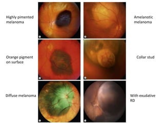 Choroidal melanoma | PPTX