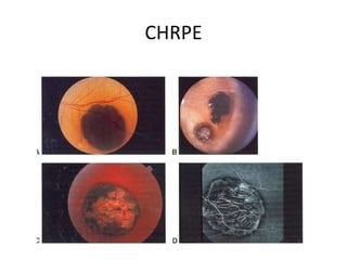 Choroidal melanoma | PPTX