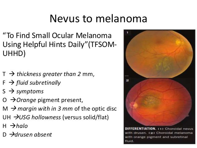 Choroidal melanoma