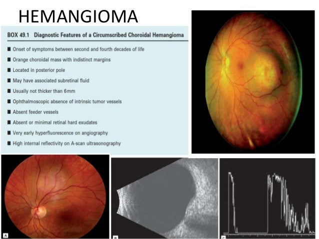 Choroidal melanoma