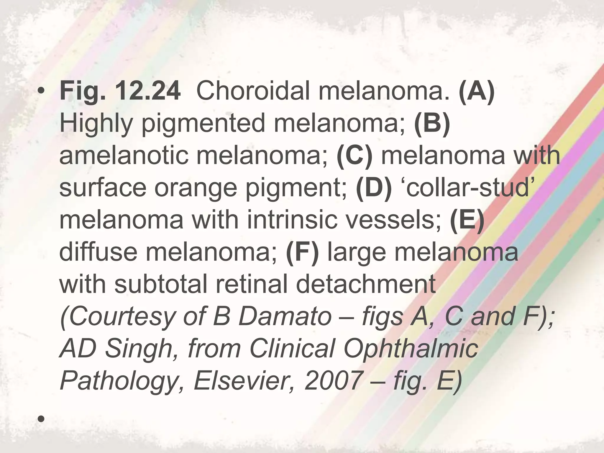 Choroidal melanoma | PPTX