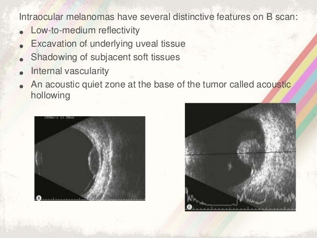 Choroidal melanoma