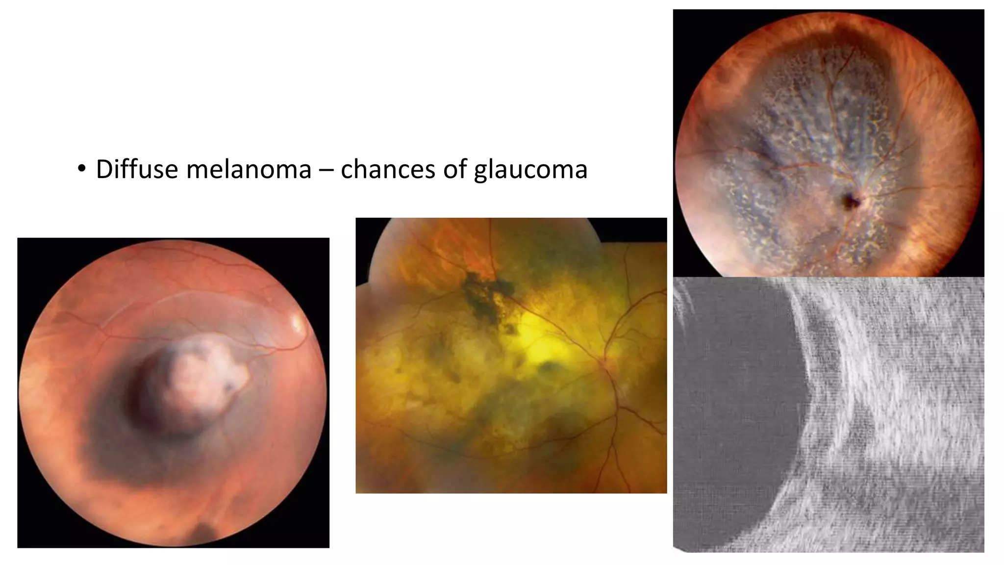Choroidal melanoma | PPTX
