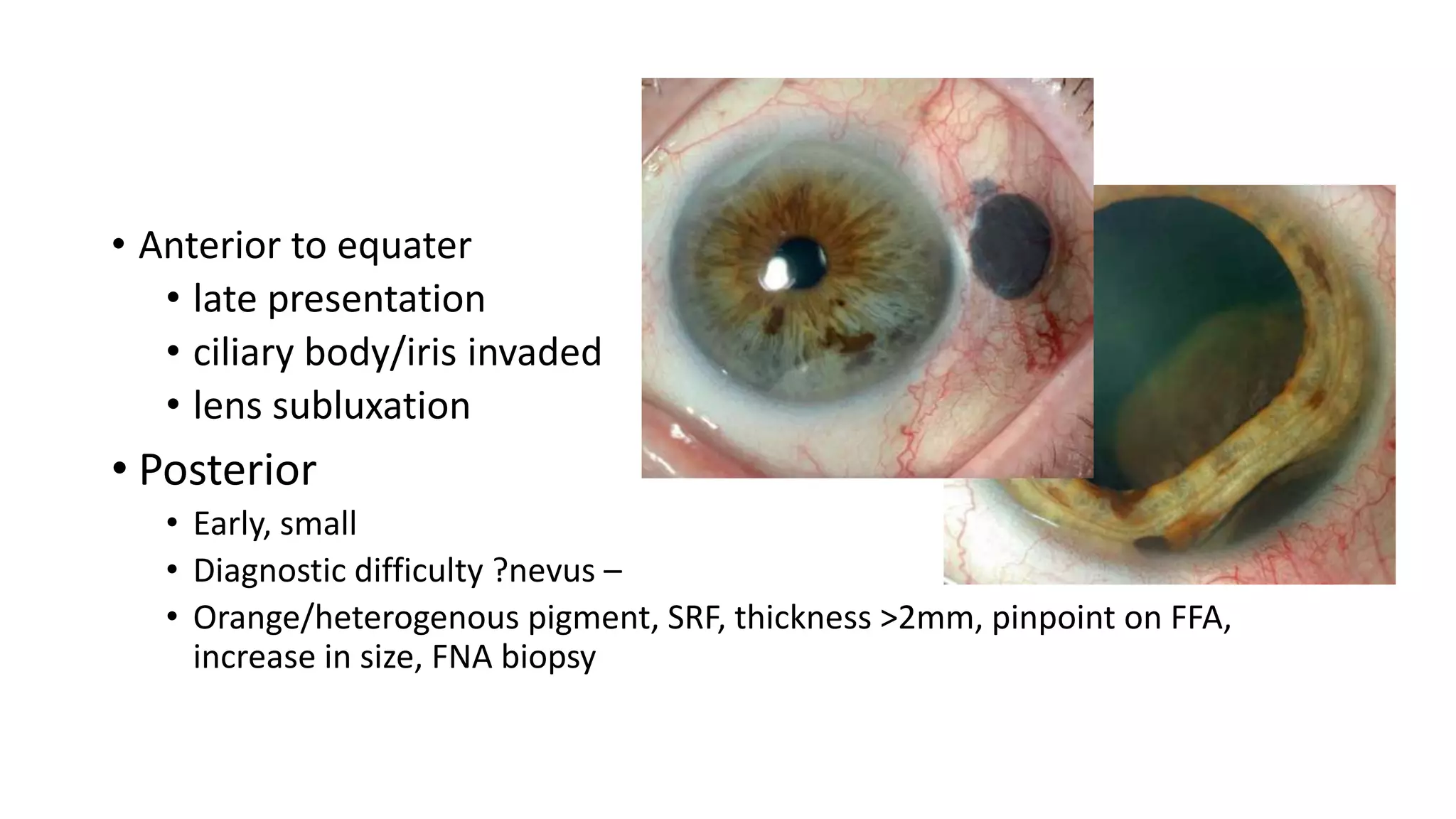 Choroidal melanoma | PPTX