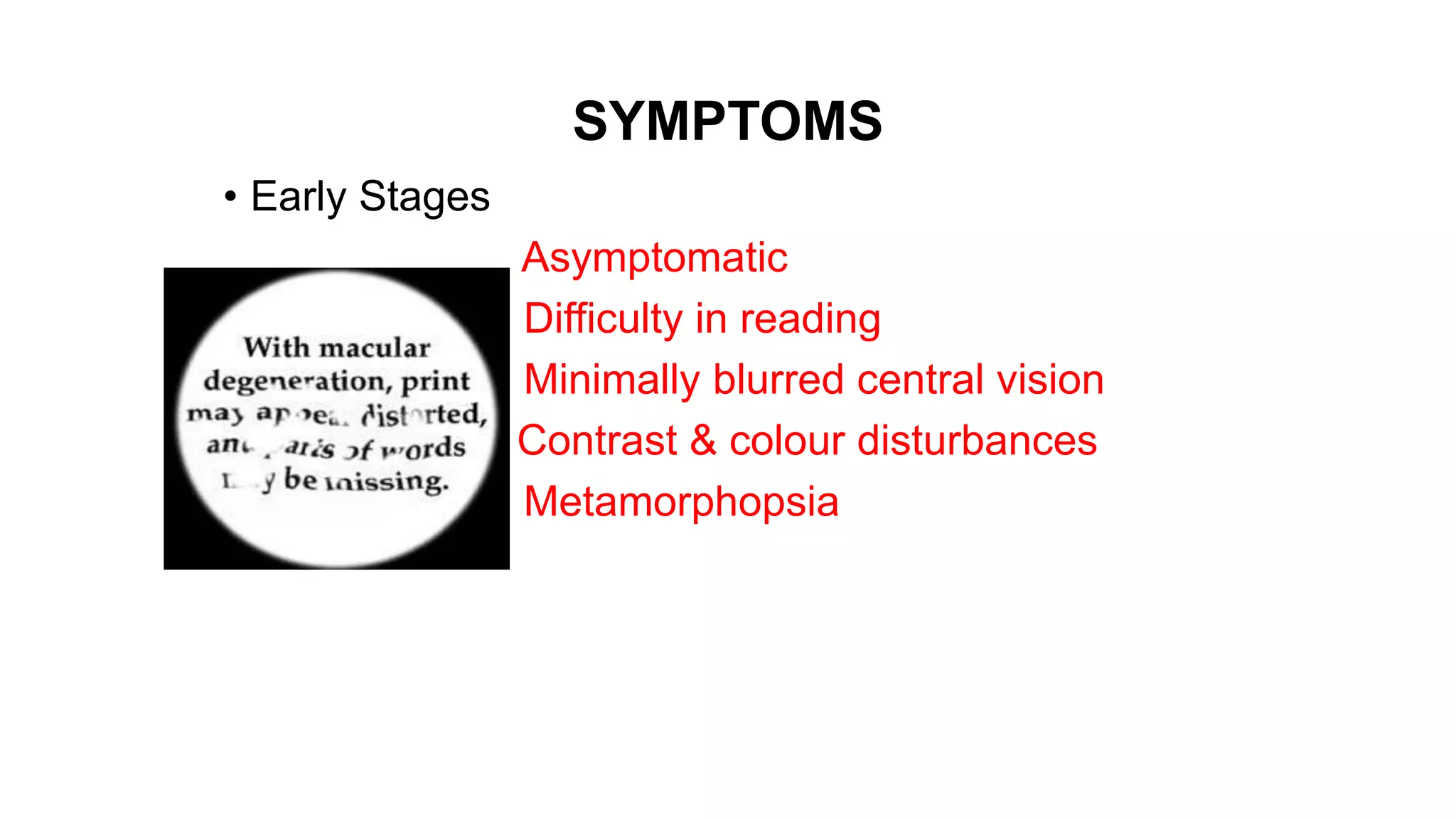 Choroidal neovascularisation(cnv) | PPTX