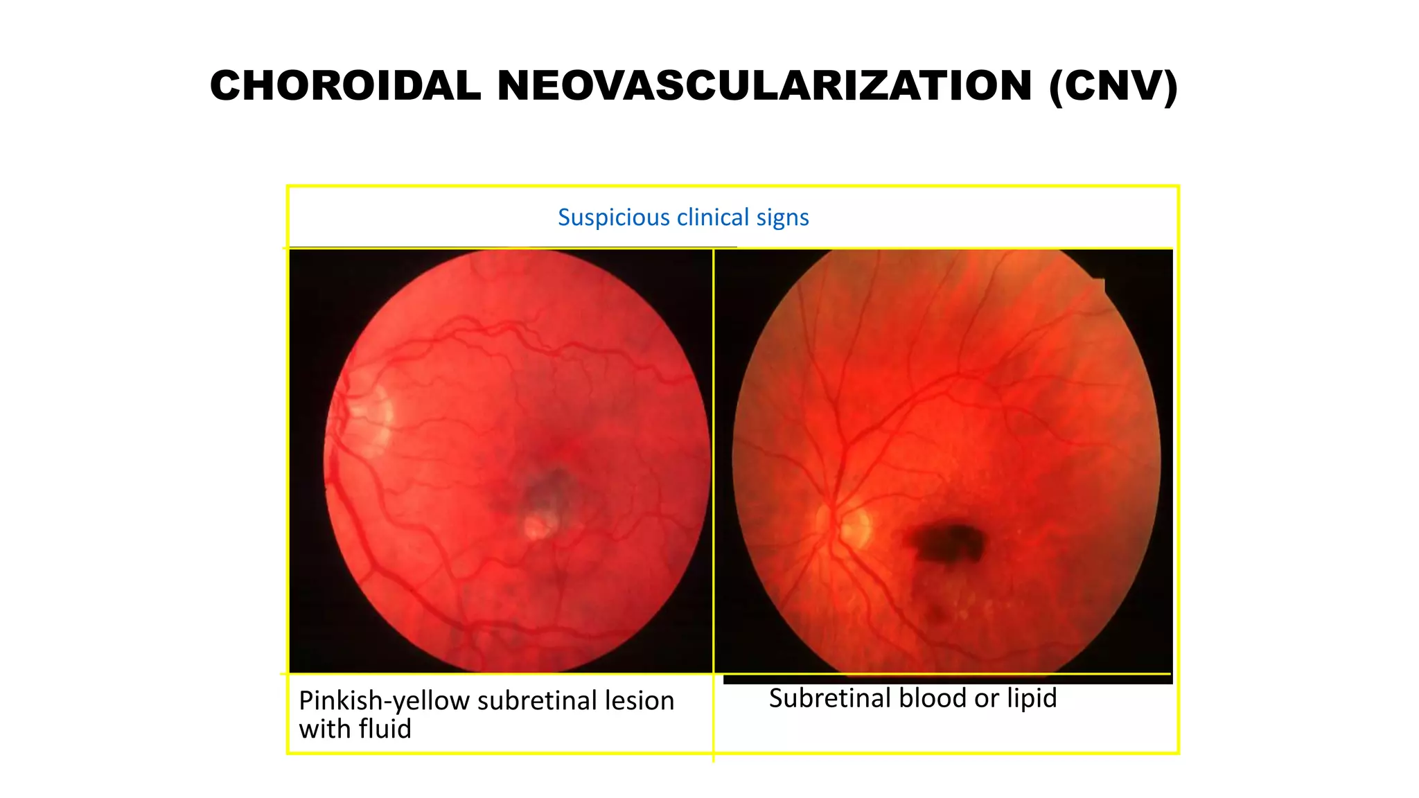 Choroidal neovascularisation(cnv) | PPTX