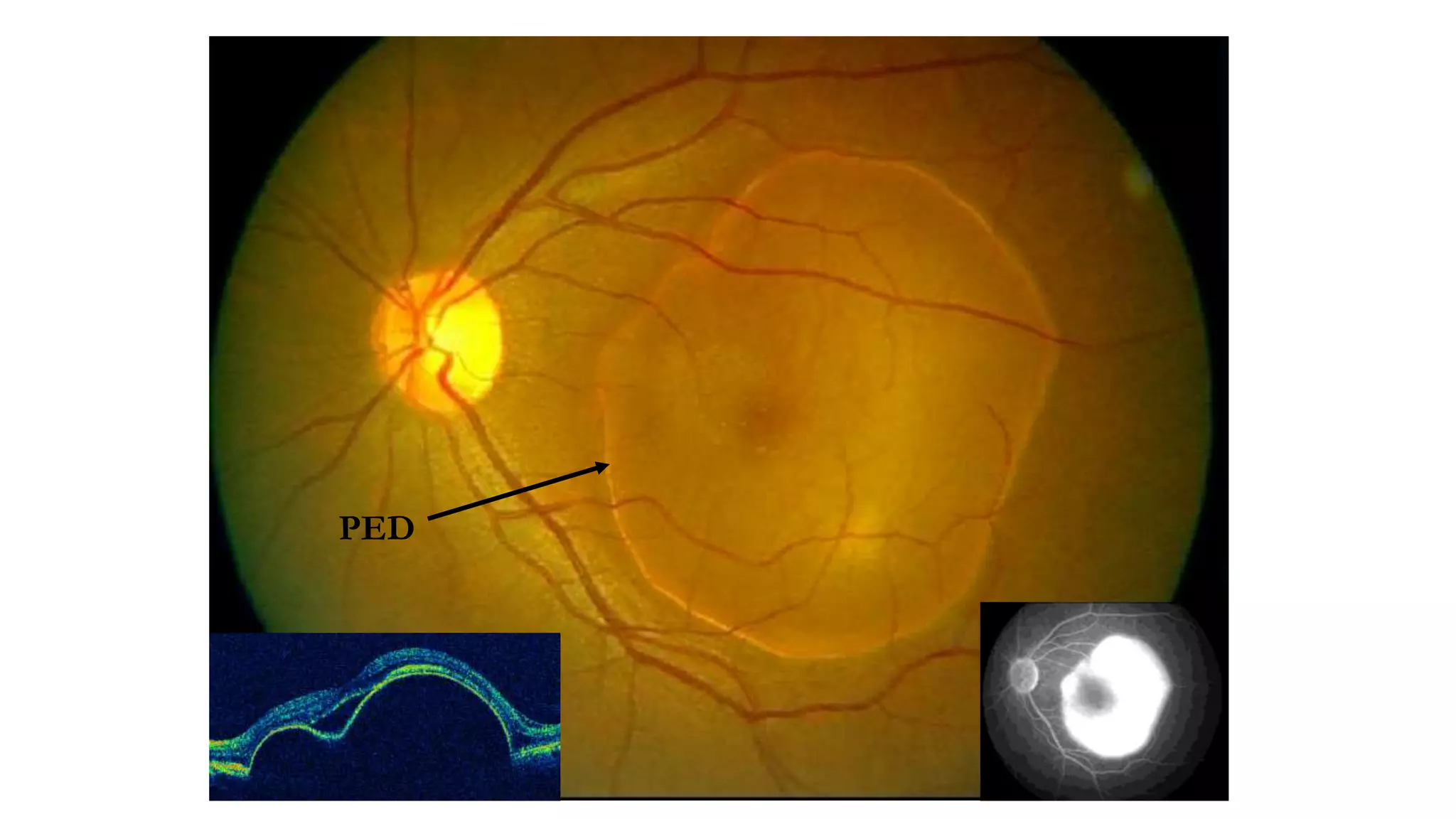 Choroidal neovascularisation(cnv) | PPTX
