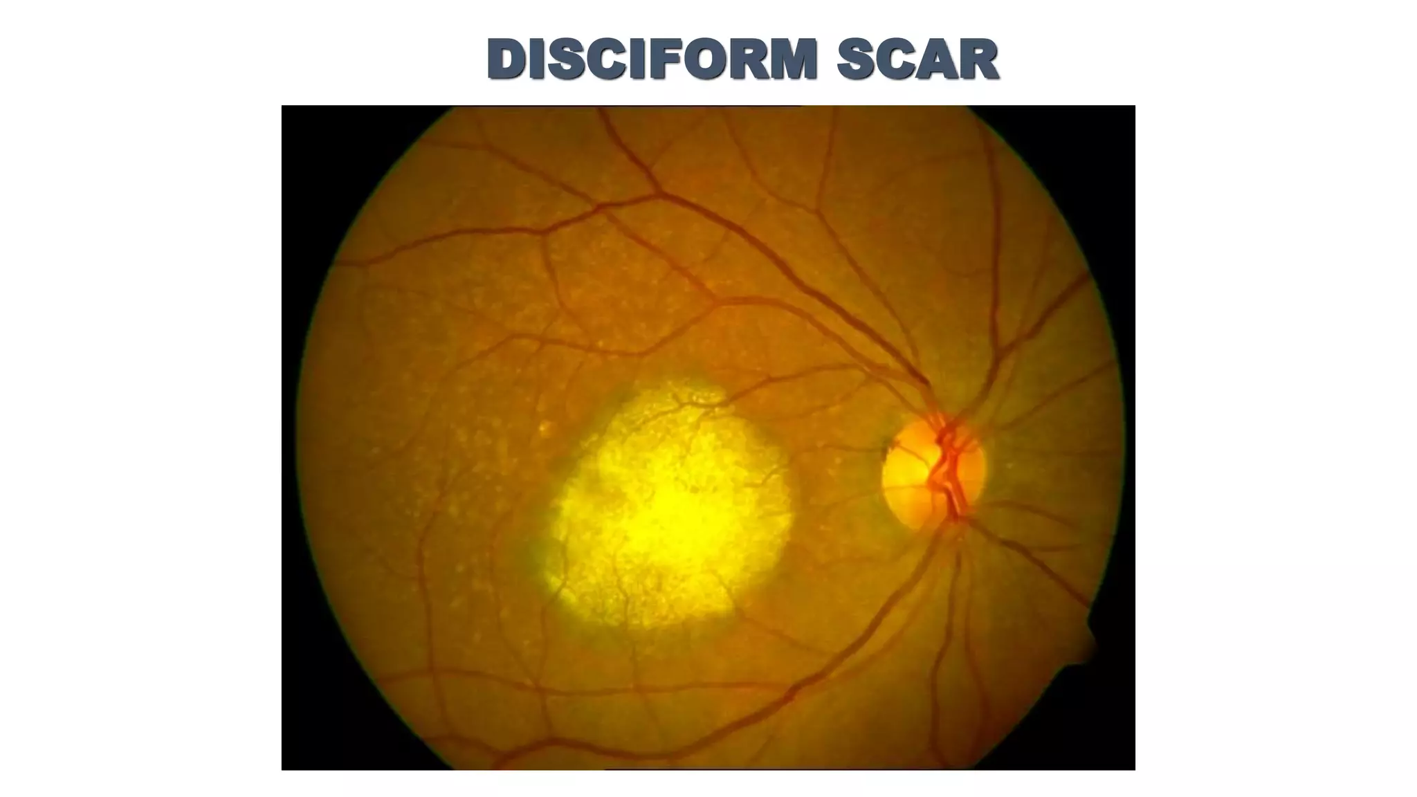 Choroidal neovascularisation(cnv) | PPTX