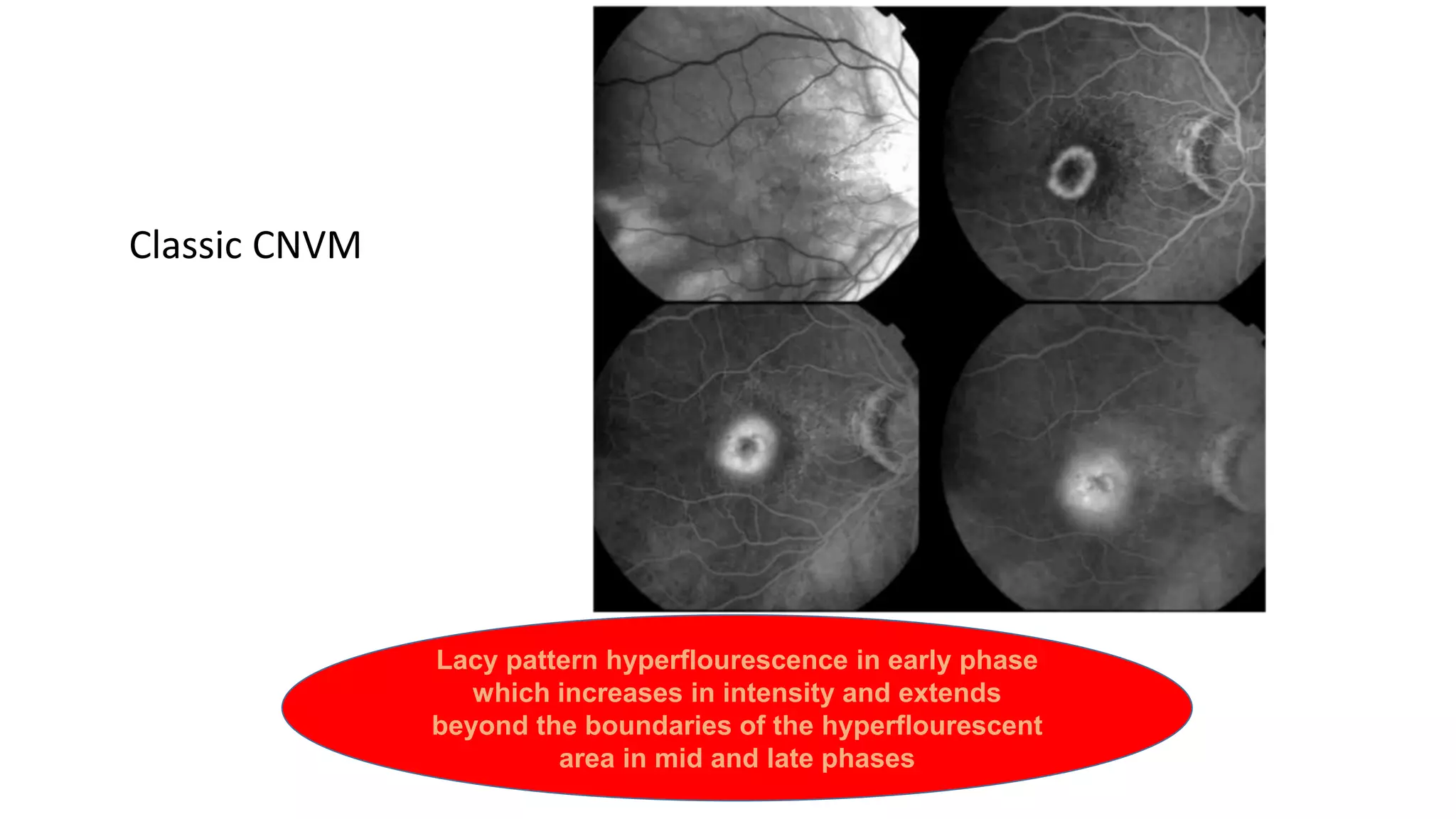 Choroidal neovascularisation(cnv) | PPTX