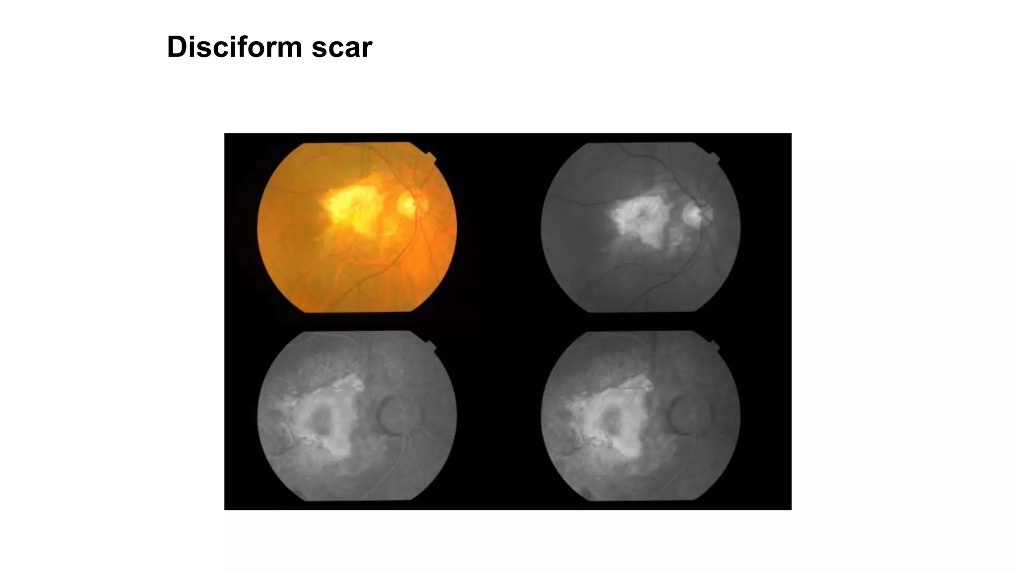 Choroidal neovascularisation(cnv) | PPTX