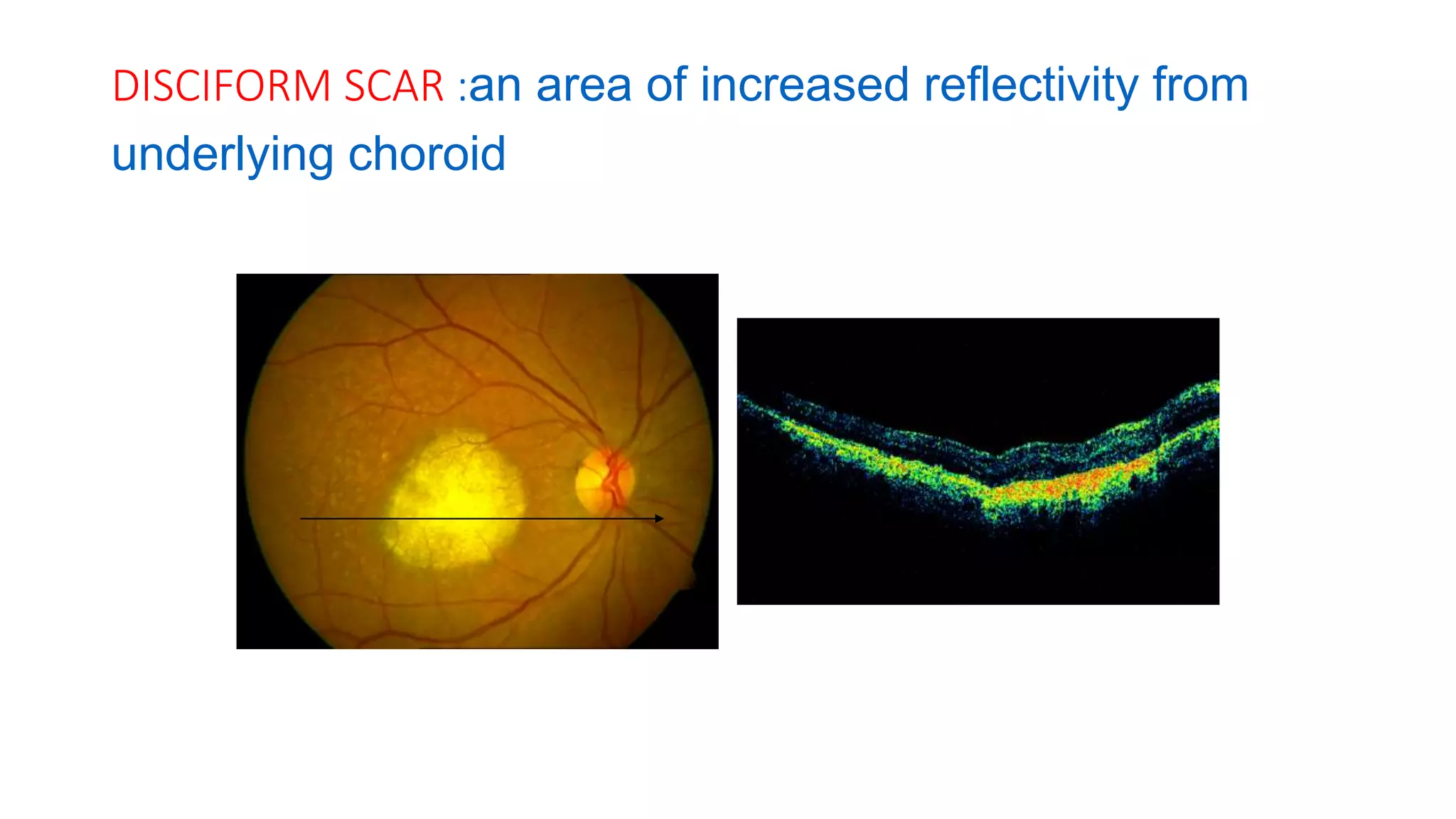 Choroidal Neovascularisation Cnv Pptx