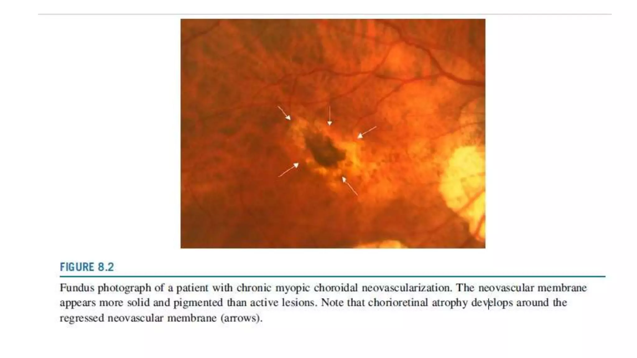 Choroidal neovascularisation(cnv) | PPTX