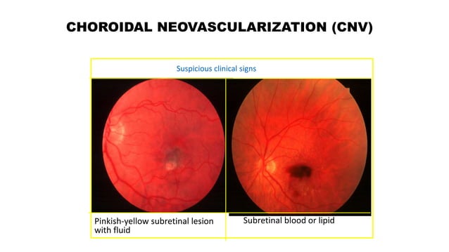 Choroidal neovascularisation(cnv) | PPTX | Eye and Vision Conditions ...