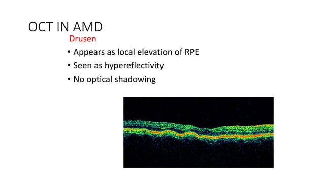 Choroidal neovascularisation(cnv) | PPTX | Eye and Vision Conditions ...