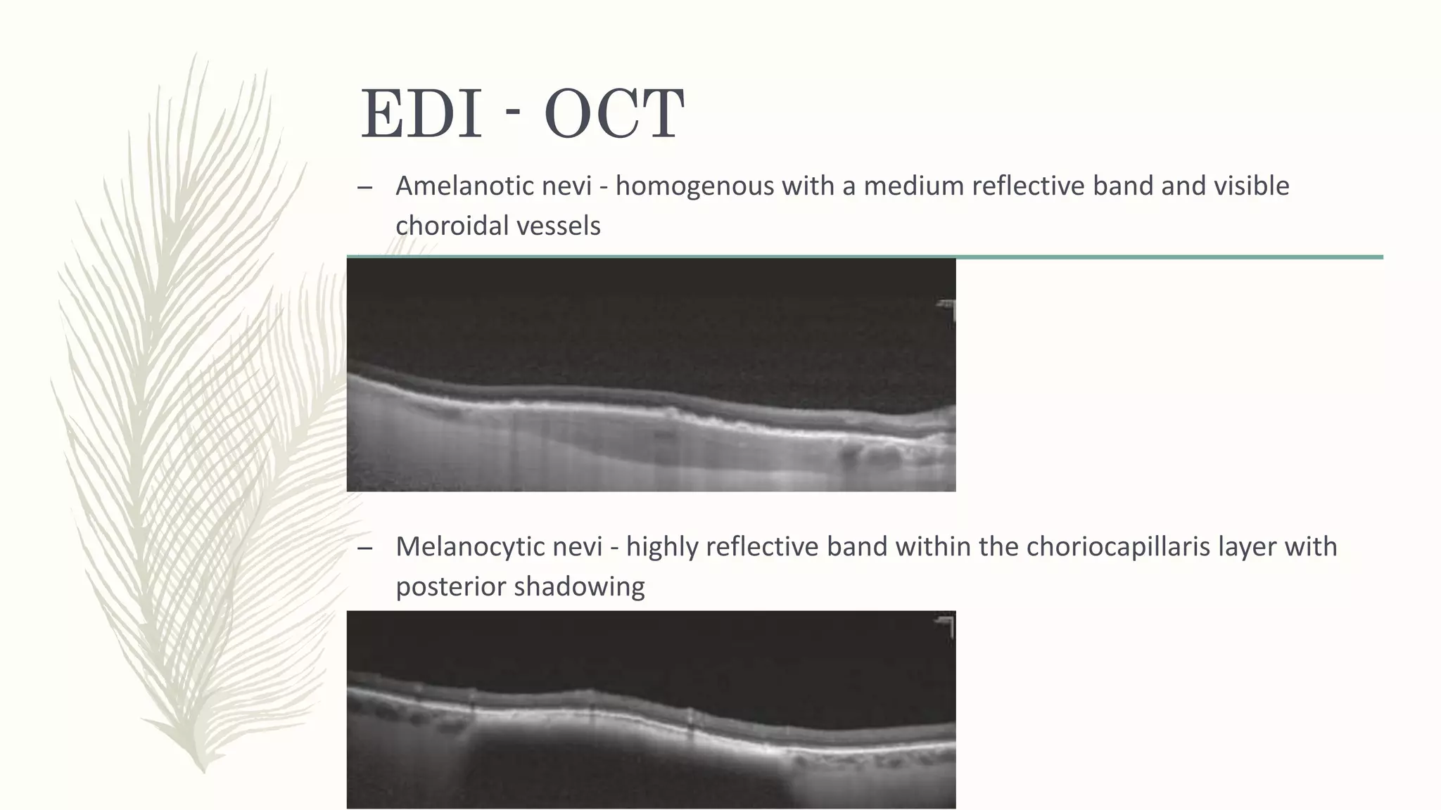 Choroidal nevus and chrpe | PPTX
