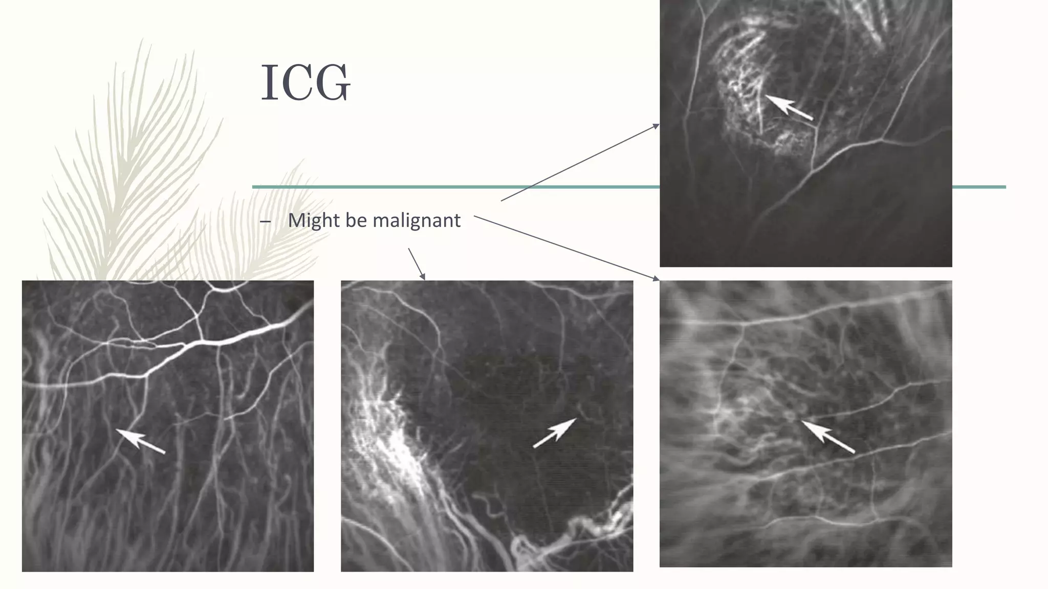 Choroidal nevus and chrpe | PPTX