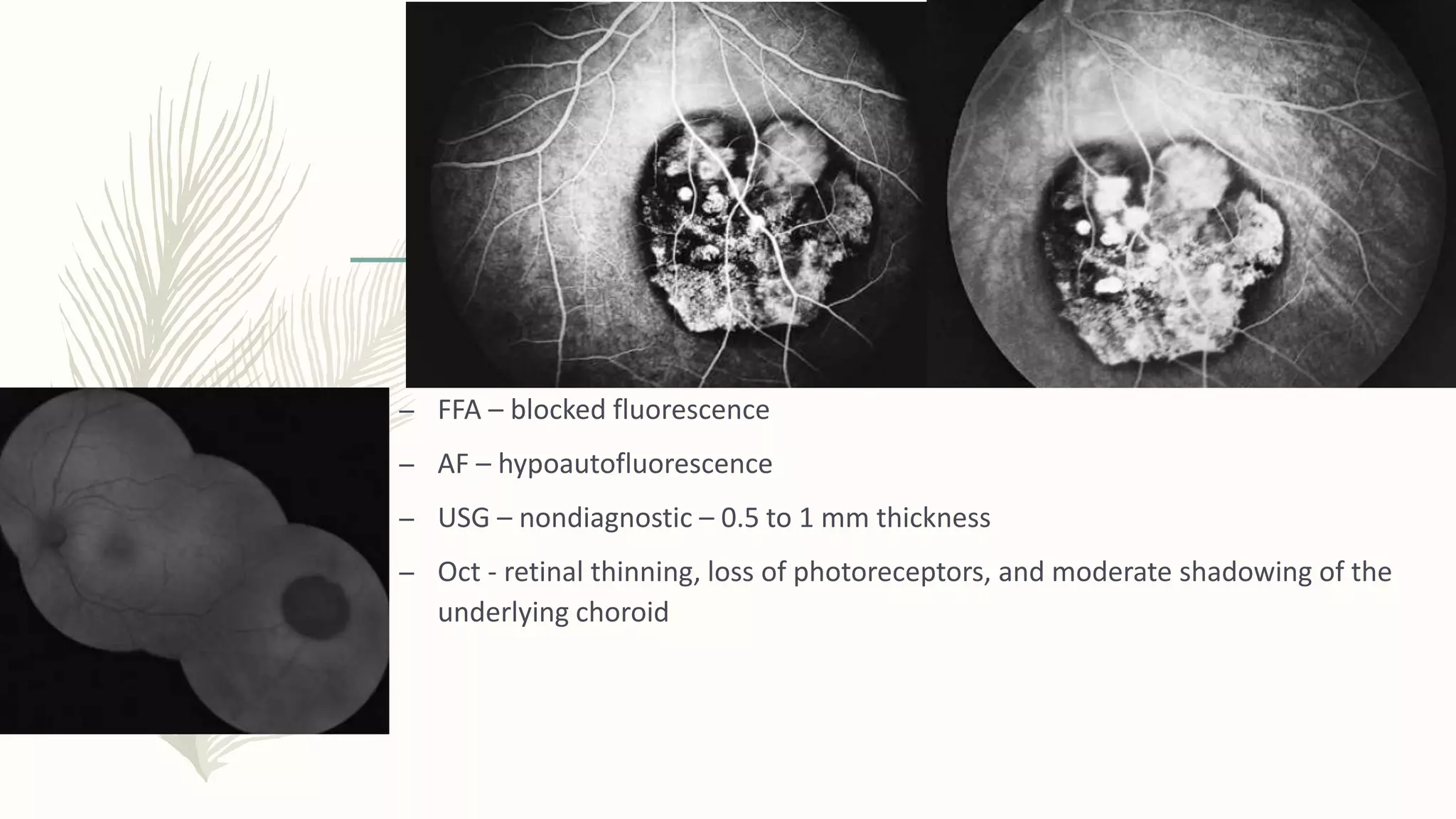Choroidal nevus and chrpe | PPTX