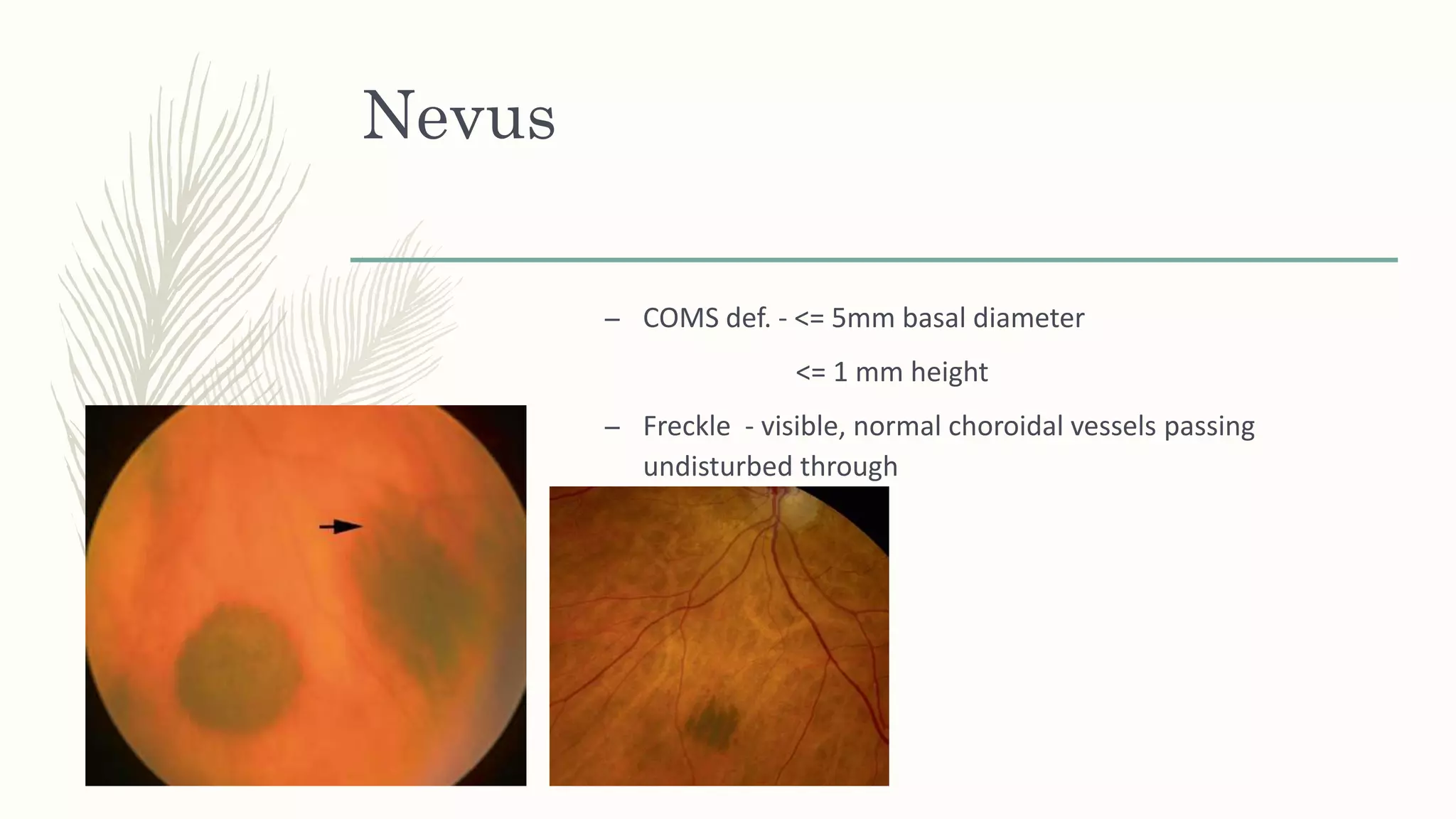 Choroidal nevus and chrpe | PPTX