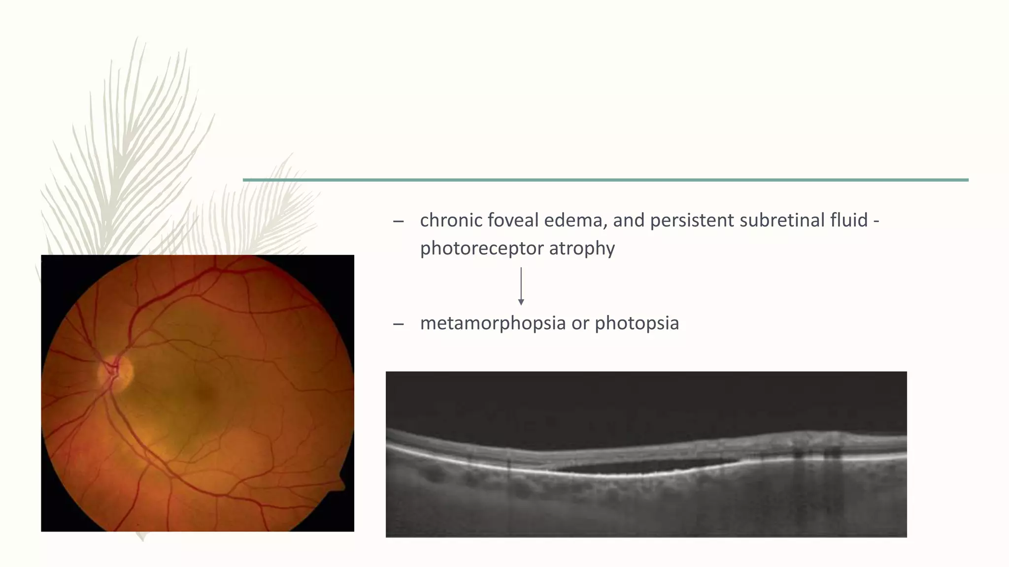 Choroidal nevus and chrpe | PPTX