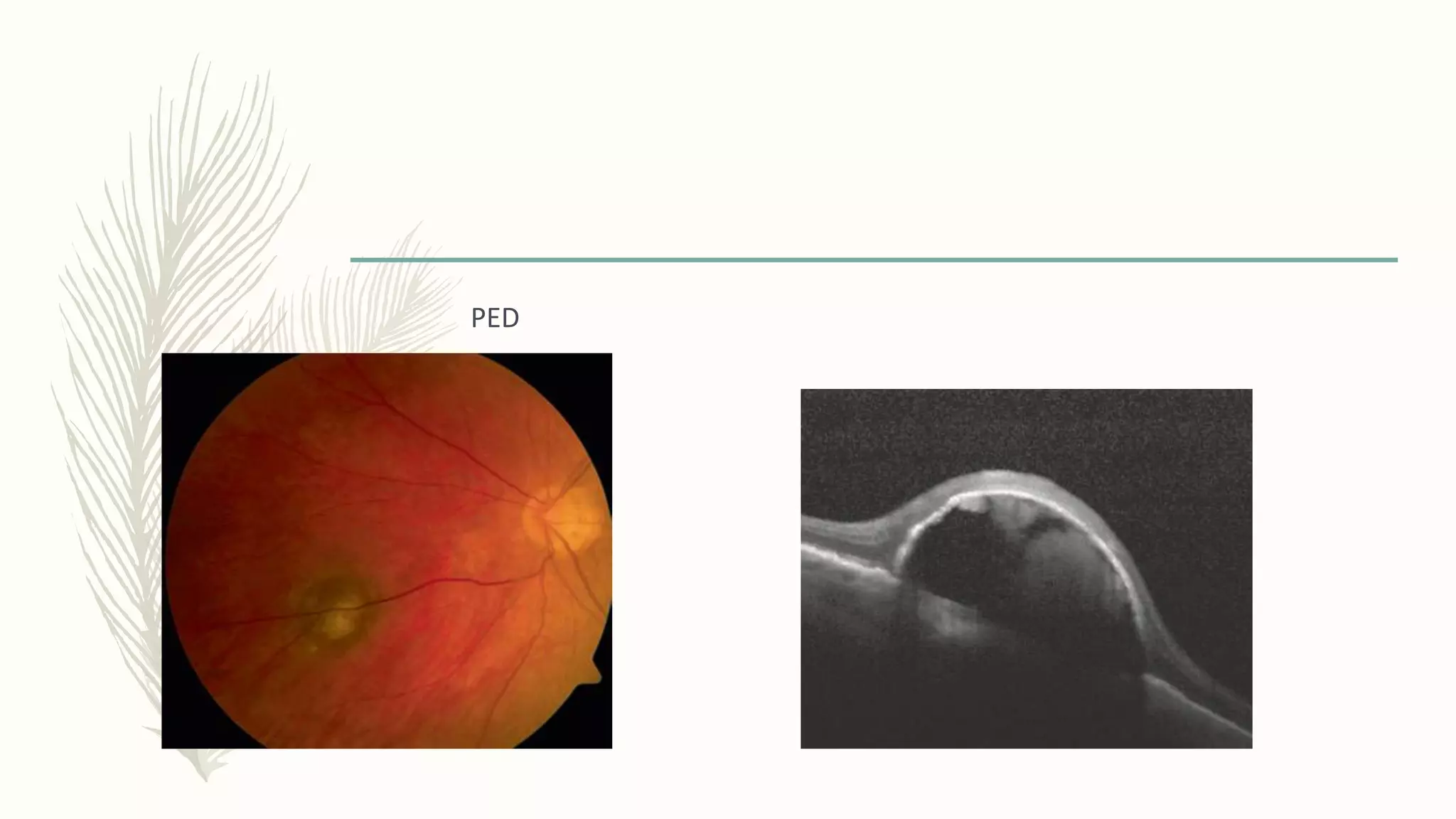 Choroidal nevus and chrpe | PPTX