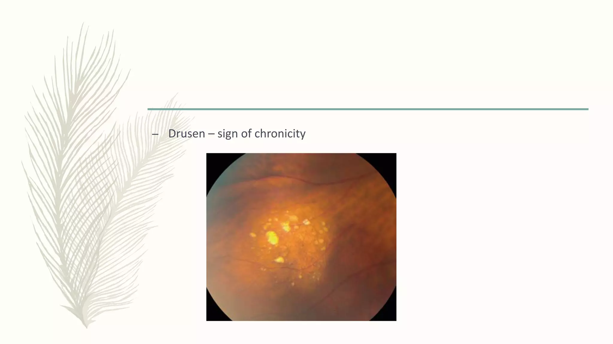 Choroidal nevus and chrpe | PPTX