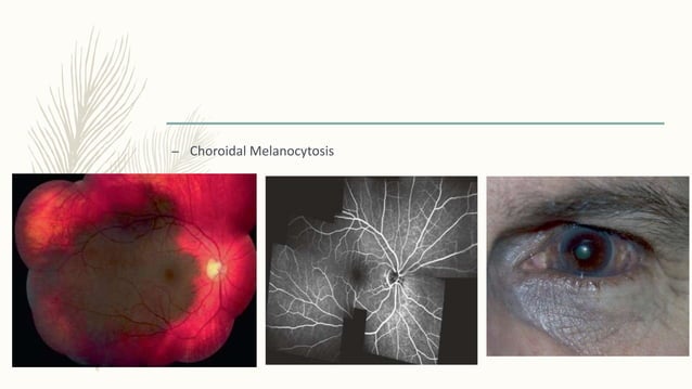 Choroidal nevus and chrpe | PPTX | Eye and Vision Conditions | Diseases ...