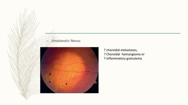 Choroidal nevus and chrpe | PPTX | Eye and Vision Conditions | Diseases ...