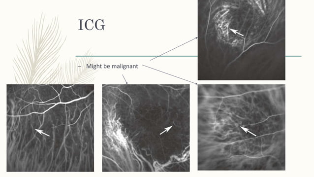 Choroidal nevus and chrpe | PPTX | Eye and Vision Conditions | Diseases ...