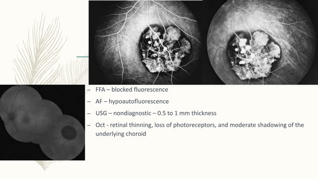 Choroidal nevus and chrpe | PPTX | Eye and Vision Conditions | Diseases ...