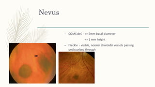 Choroidal nevus and chrpe | PPTX