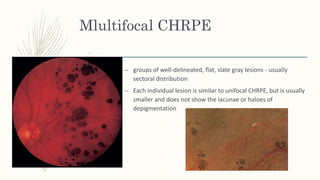 Choroidal nevus and chrpe | PPTX