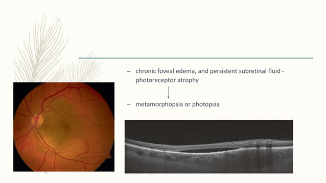 Choroidal nevus and chrpe | PPTX | Eye and Vision Conditions | Diseases ...